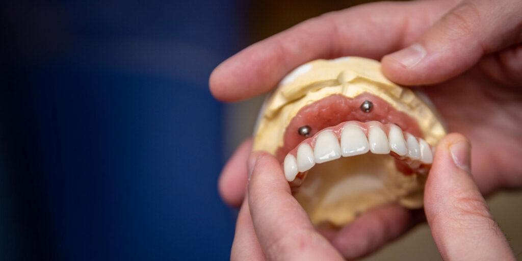 Zirconia Fixed Bridge | Brielle, NJ | Brielle Dentistry